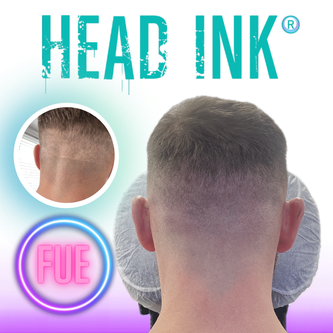 Scalp Micropigmentation – Scar camouflage - scalp micro pigmentation ...