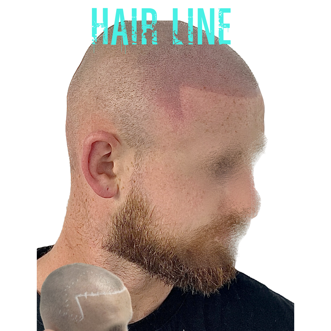 SMP Hairline enhancement - Scalp Micropigmentation Northampton
